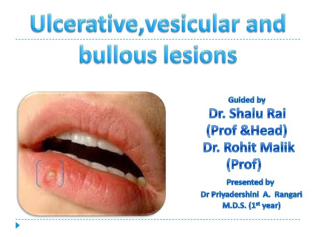 Priya seminar on ulcerative,vesicular and bullous lesions