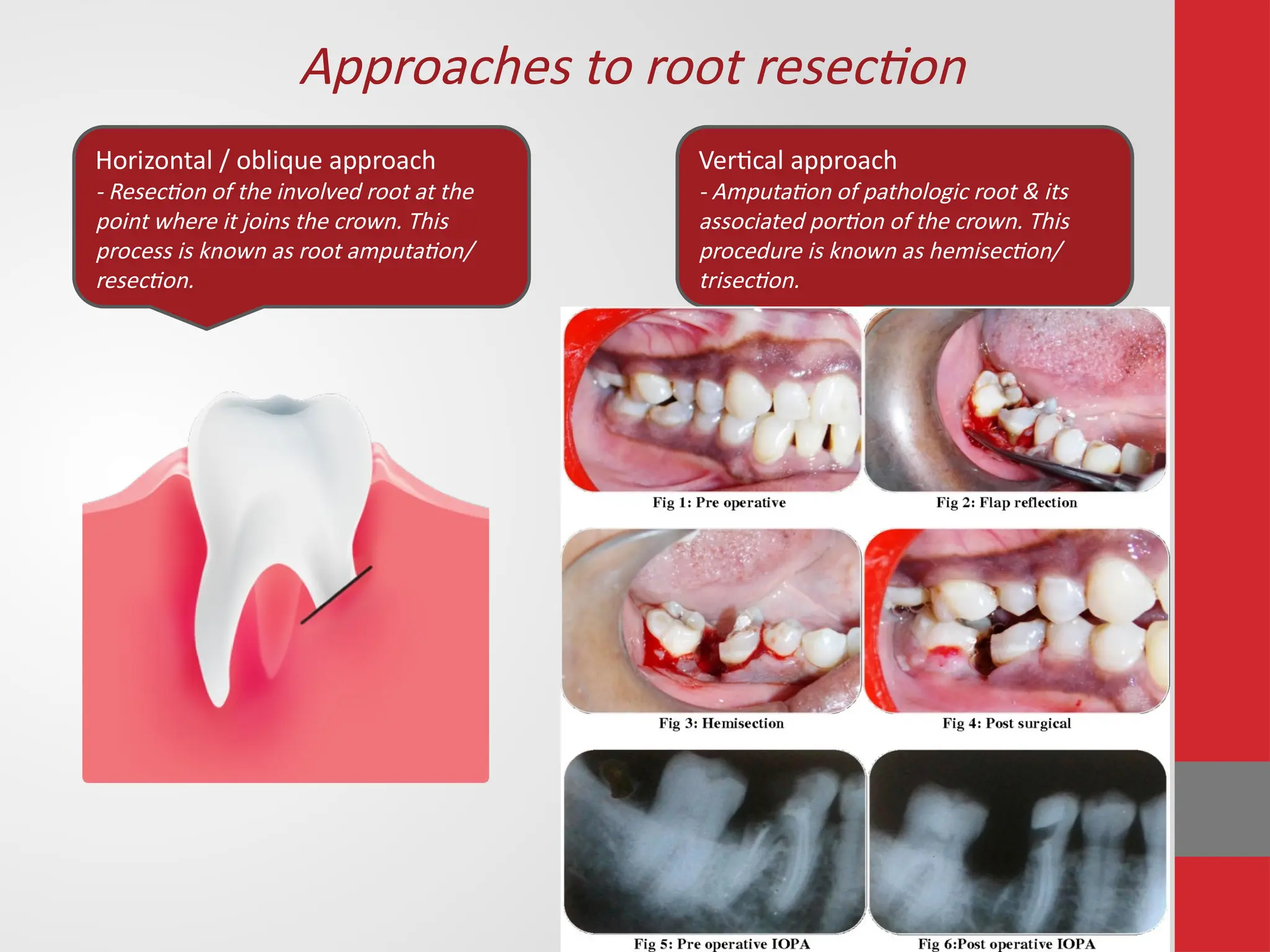 FURCATION INVOLVEMENT COMPLICATIONS IN PERIODONTICS | PPTX