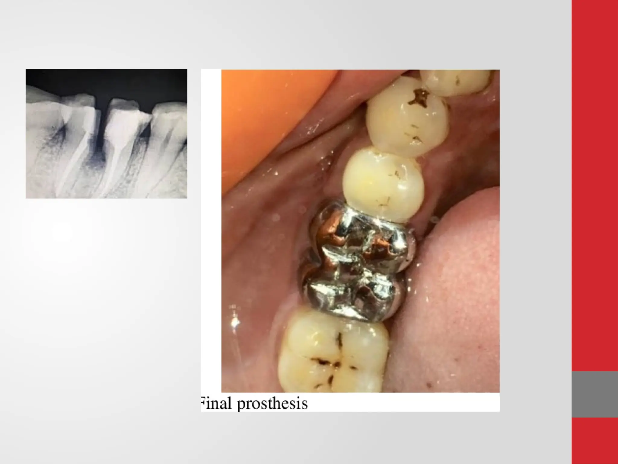 FURCATION INVOLVEMENT COMPLICATIONS IN PERIODONTICS | PPTX