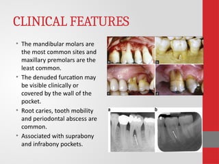 FURCATION INVOLVEMENT COMPLICATIONS IN PERIODONTICS | PPTX
