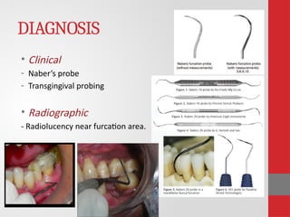 FURCATION INVOLVEMENT COMPLICATIONS IN PERIODONTICS | PPTX