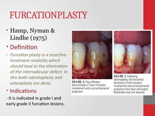 FURCATION INVOLVEMENT COMPLICATIONS IN PERIODONTICS | PPTX