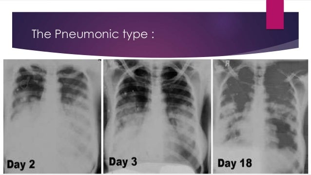 Pneumonic Plague Symptoms Epidemiology And Prevention Of Plague