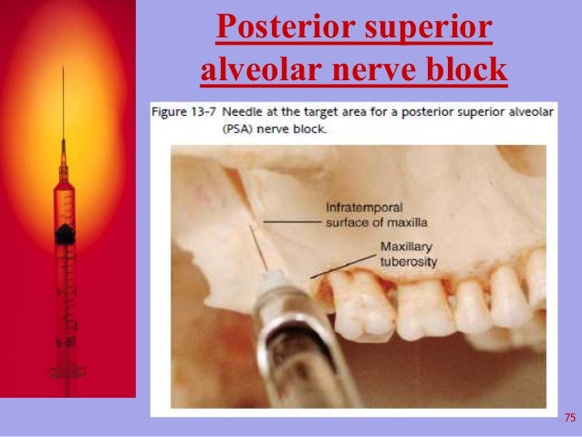 Local Anesthesia in Dentistry