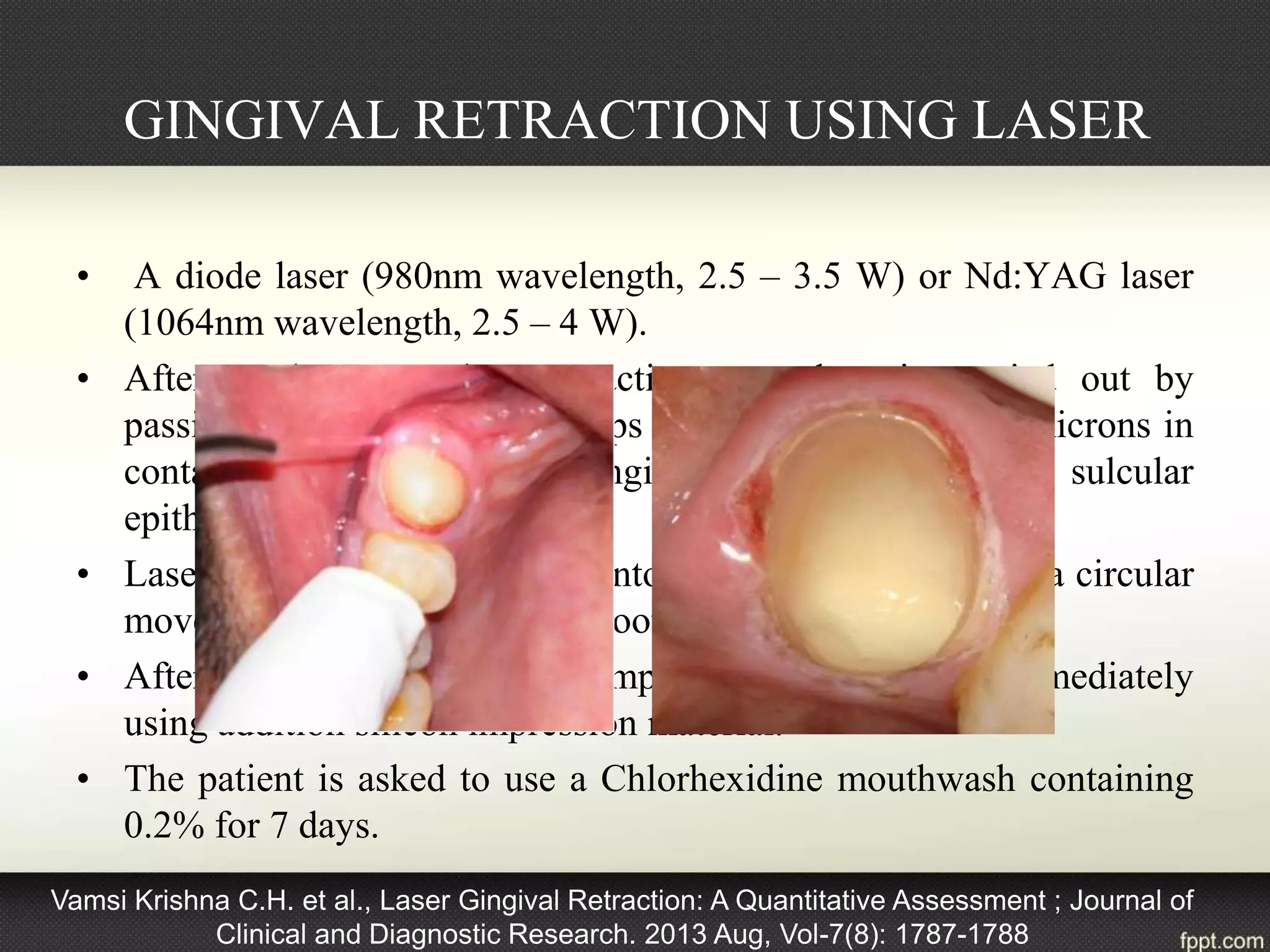 Lasers in Prosthetic Dentistry | PPTX