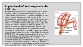surgery appendicular filltrate about definition to treatment | PPTX