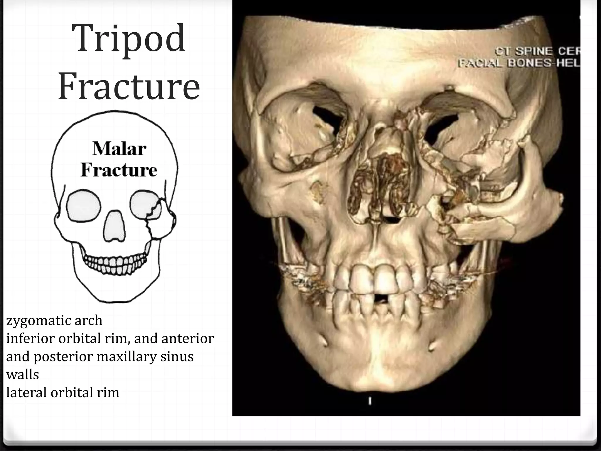 Facial fracture | PPTX