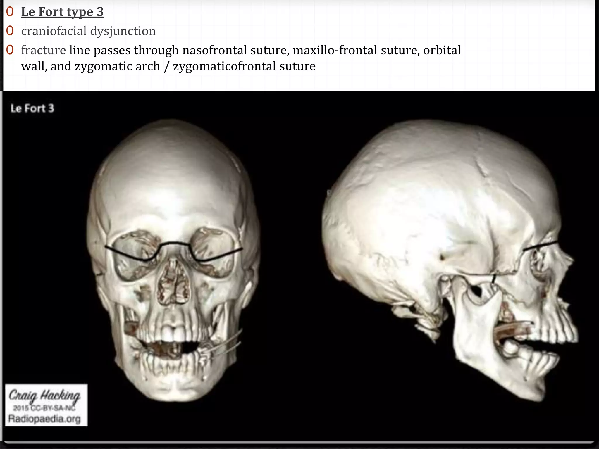 Facial fracture | PPTX