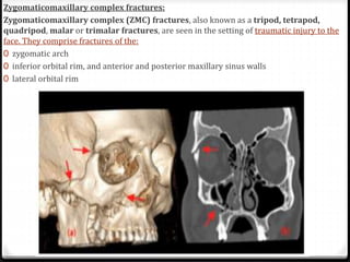 Facial fracture | PPTX