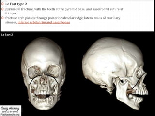 Facial fracture | PPTX