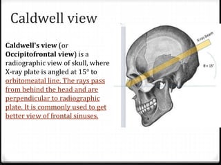 Facial fracture | PPTX