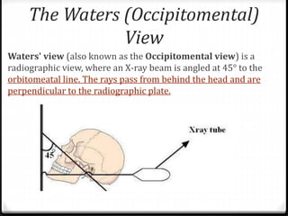 Facial fracture | PPTX