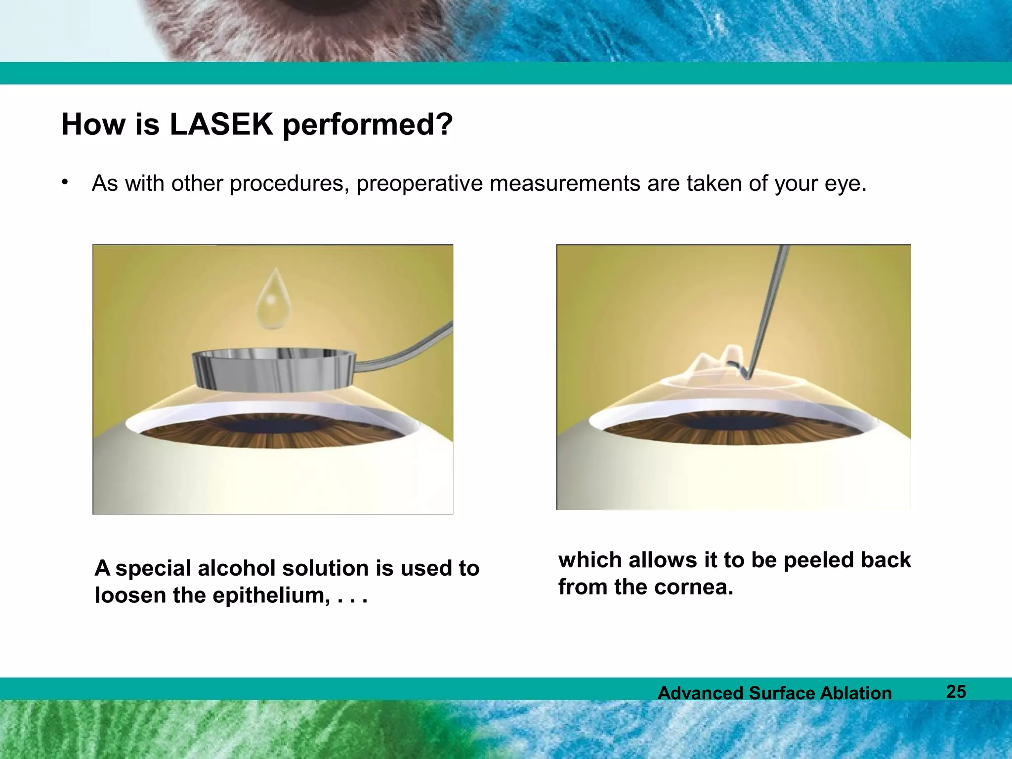 PRK or advanced surface ablation 2017 | ODP