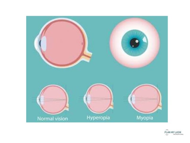 Prk vs lasik eye surgery | PPTX