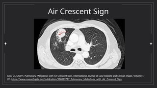 Mikosis Paru/pulmonary mycosis/aspergillosis.pptx