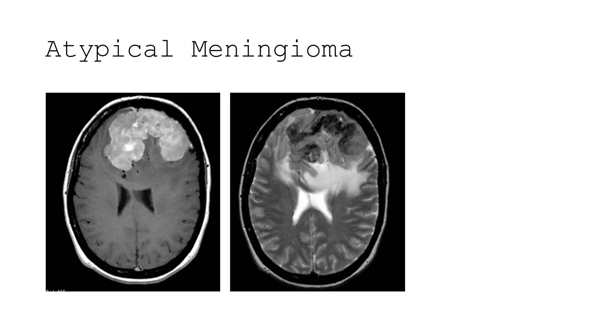 Neuroradiologi mengenai MRI dan CT scan pasien tumor otak | PPT