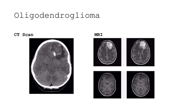Neuroradiologi mengenai MRI dan CT scan pasien tumor otak | PPT