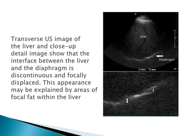 Probe construction, types and usg artefacts | PPT