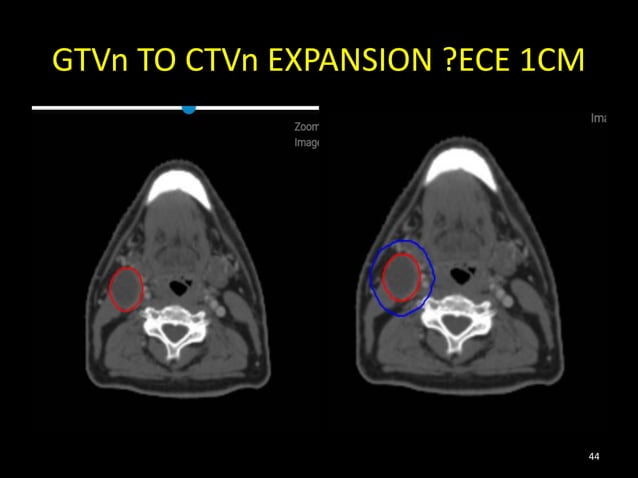 Delineation Of Nodal Volumes And Oars A Problem Based Approach Ppt