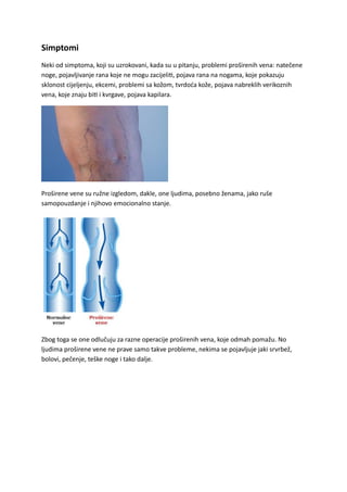 Problemi sa proširenim venama | PDF