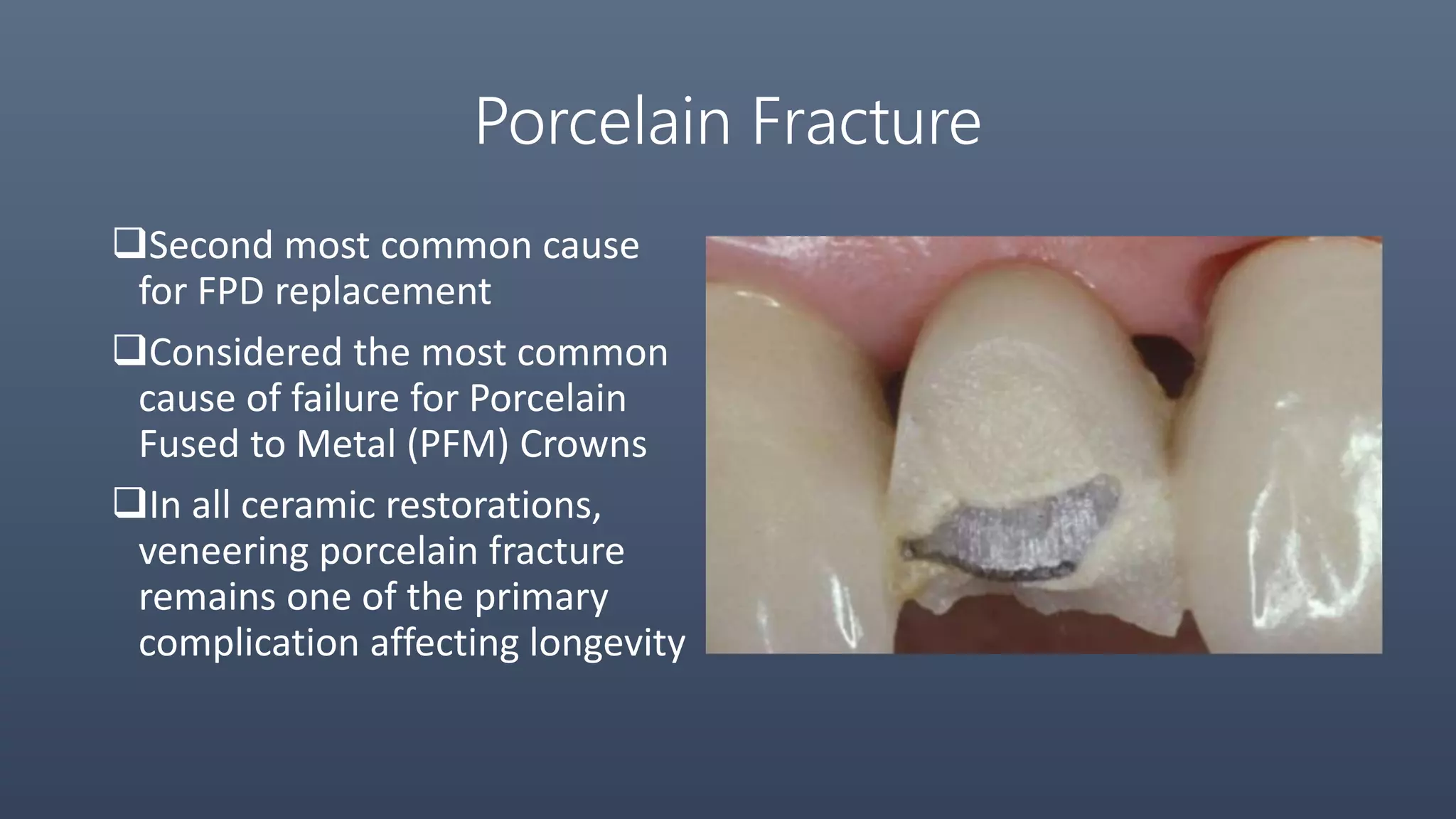 Failures in Fixed Partial Denture | PPTX