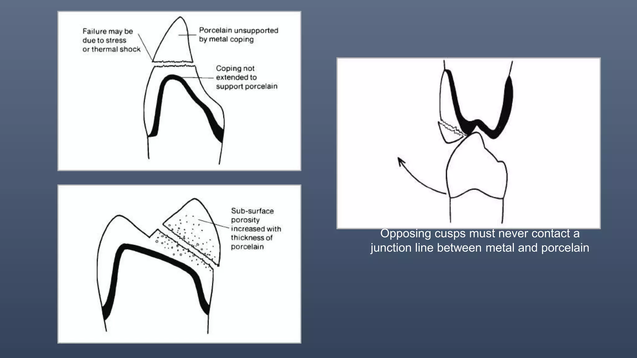 Failures in Fixed Partial Denture | PPTX