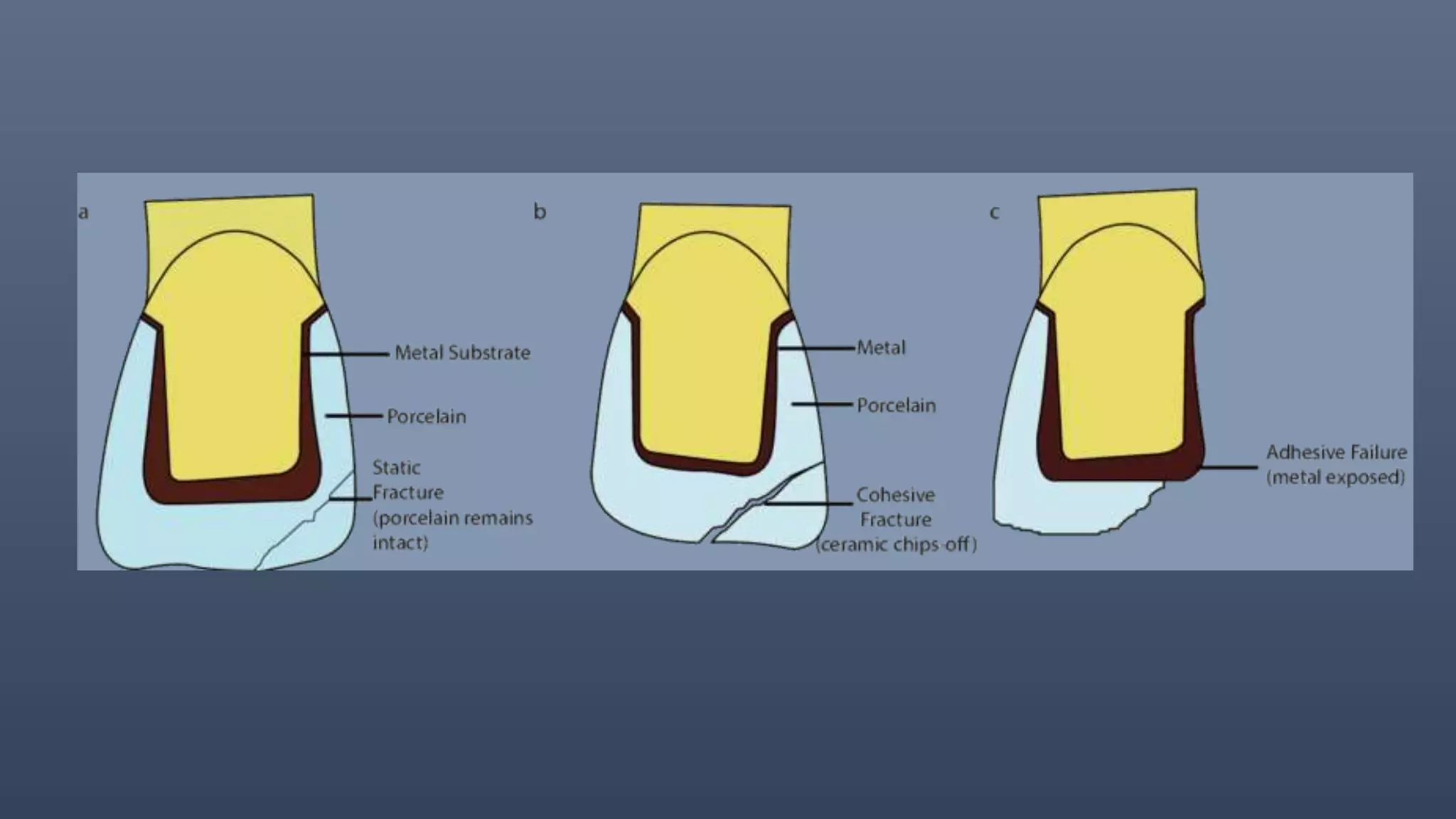 Failures in Fixed Partial Denture | PPTX