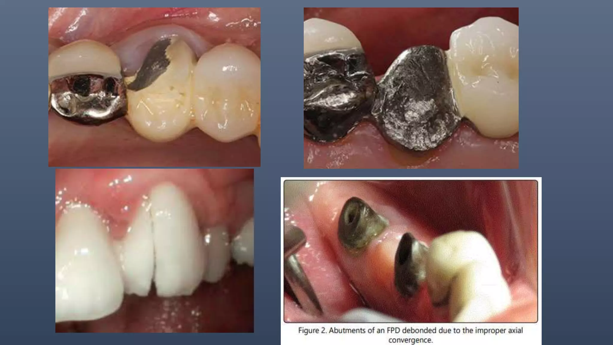 Failures in Fixed Partial Denture | PPTX