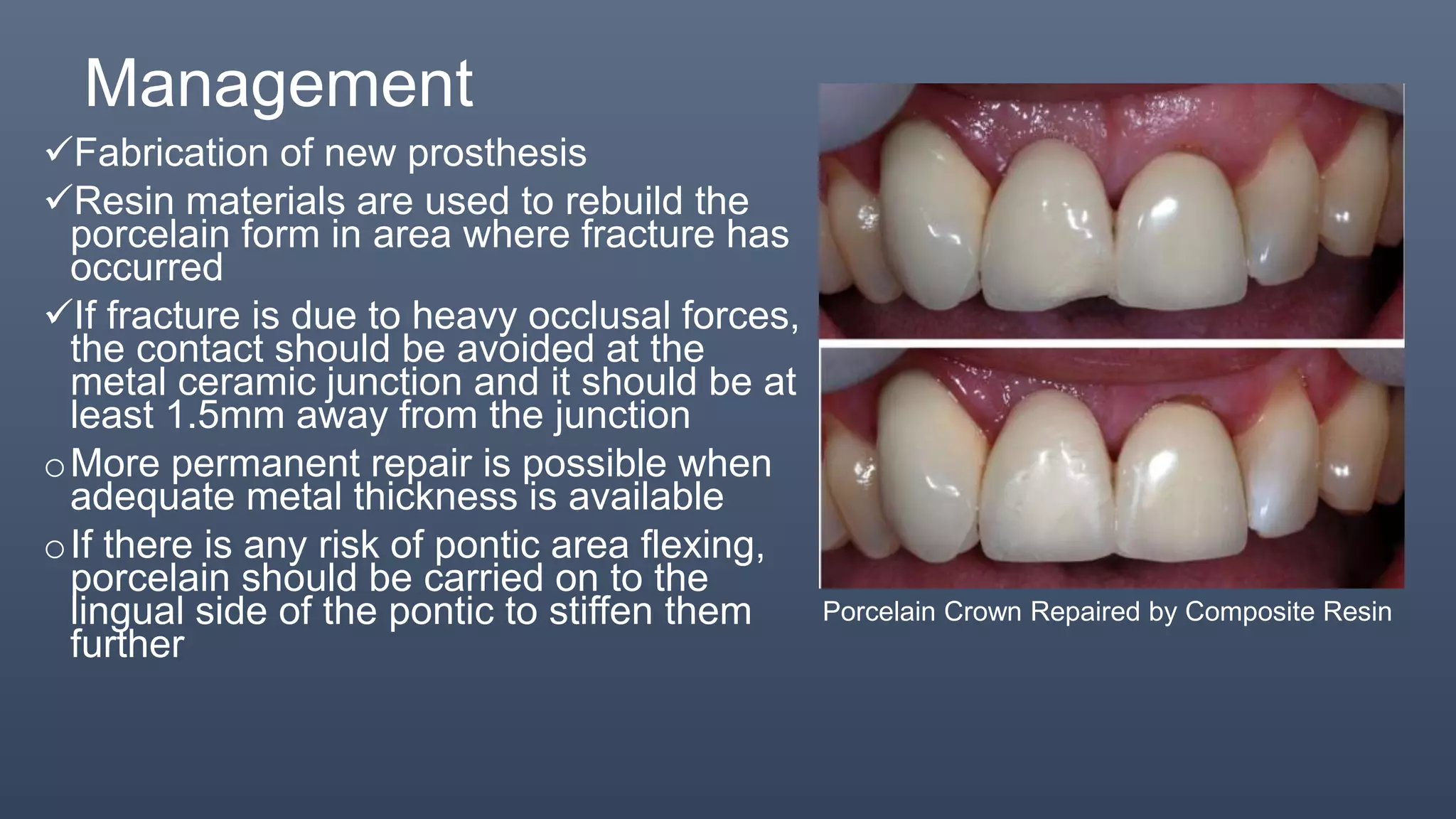 Failures in Fixed Partial Denture | PPTX