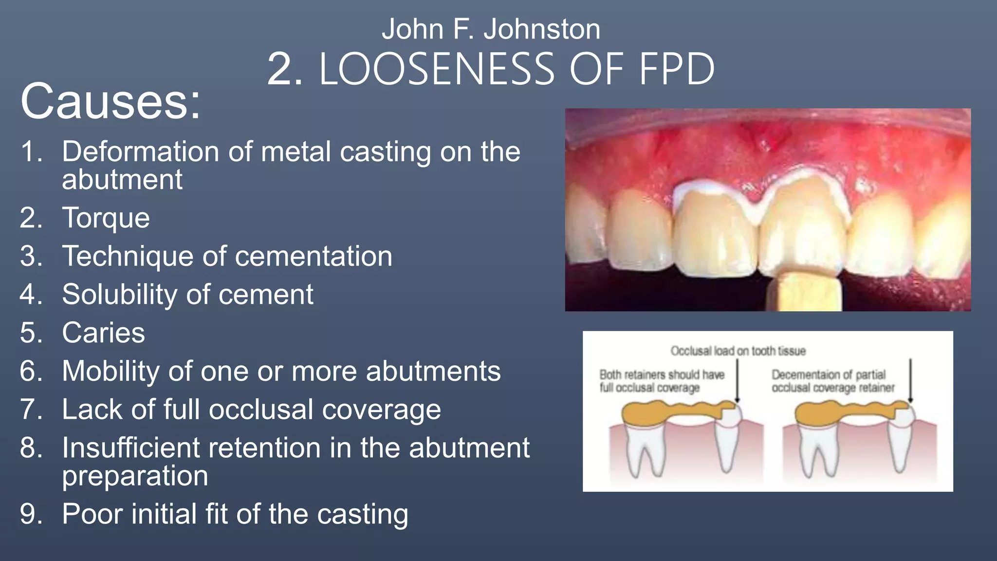 Failures in Fixed Partial Denture | PPTX