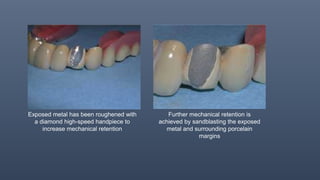 Failures in Fixed Partial Denture | PPTX