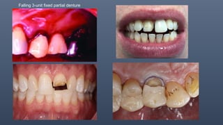 Failures in Fixed Partial Denture | PPTX