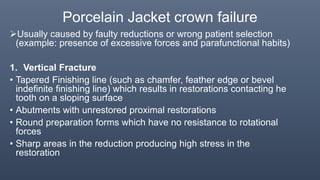 Failures in Fixed Partial Denture | PPTX
