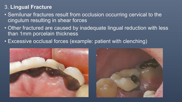 Failures in Fixed Partial Denture | PPTX