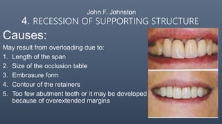 Failures in Fixed Partial Denture | PPTX