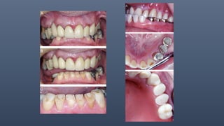 Failures in Fixed Partial Denture | PPTX