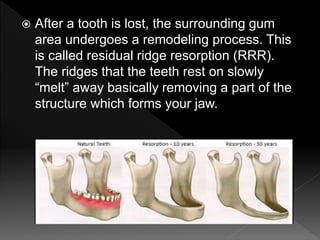 Problems in missing teeth | PPT