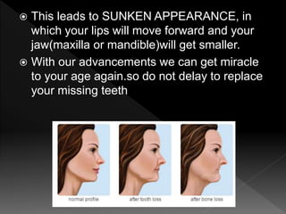 Problems in missing teeth | PPTX