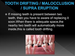 Problems in missing teeth | PPT