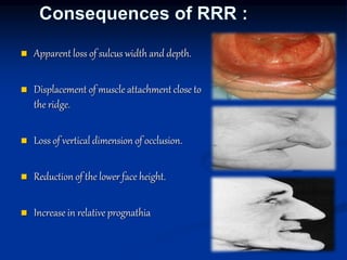 problems of residual alveolar ridge.ppt