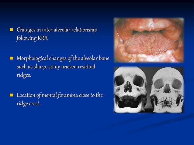 problems of residual alveolar ridge.ppt