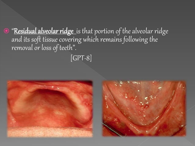 problems of residual alveolar ridge.ppt