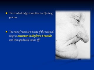 problems of residual alveolar ridge.ppt