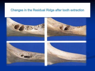 problems of residual alveolar ridge.ppt