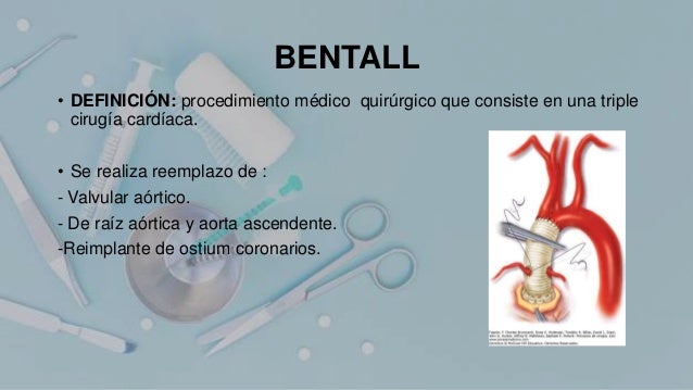 Procedimiento de bentall bono