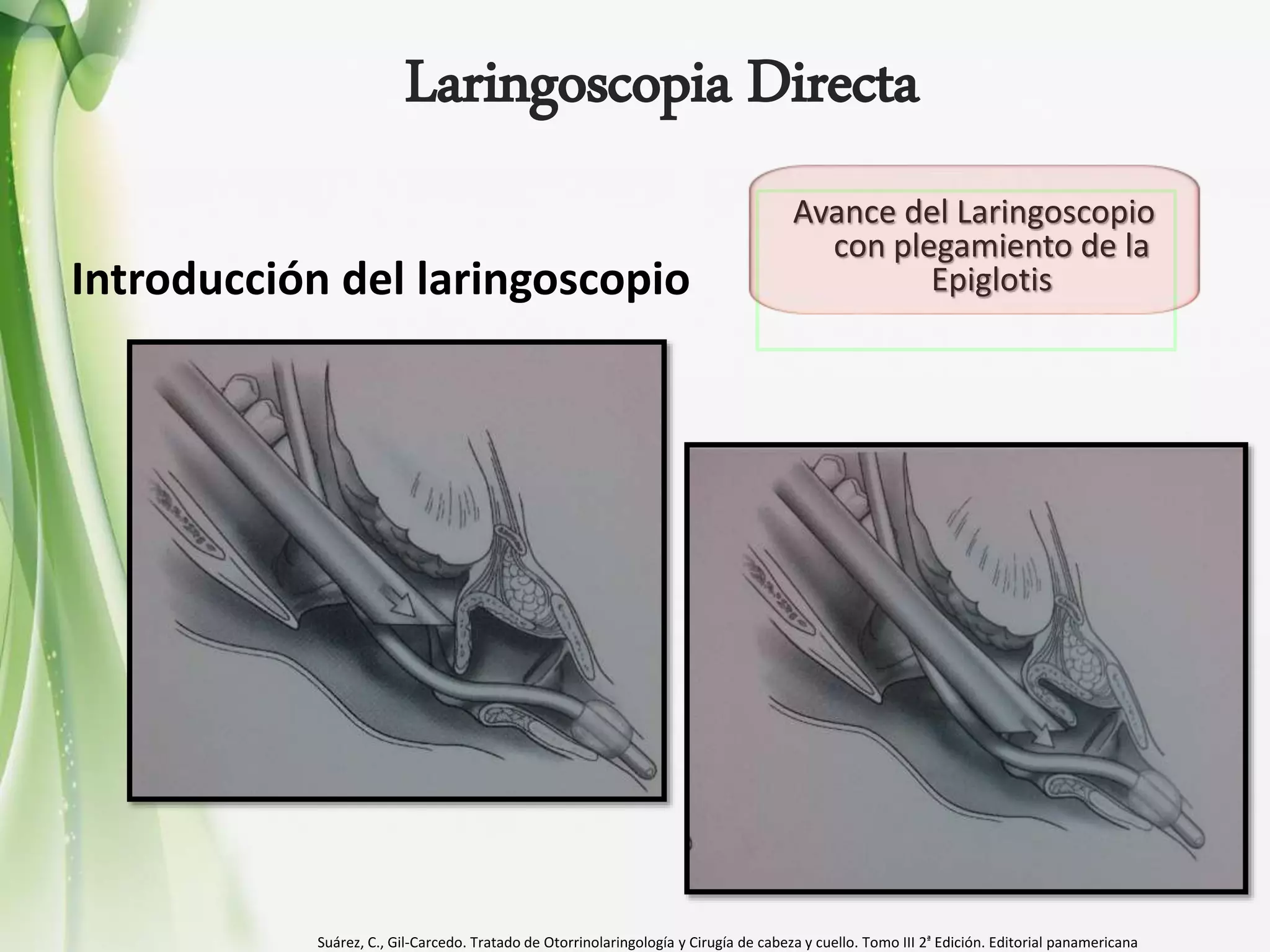 Procedimientos diagnosticos en laringe | PPTX