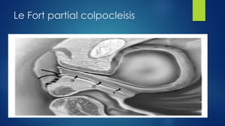 Procedimientos quirurgicos en cervix uterino | PPTX