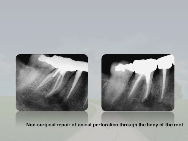 Procedural accidents in root canal treatment last one
