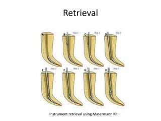 Procedural Errors in Biomecanical Preparation | PPTX