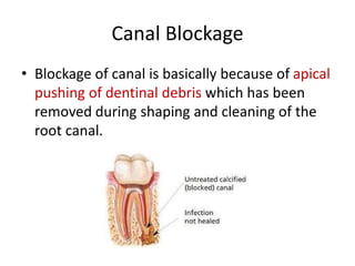 Procedural Errors in Biomecanical Preparation | PPTX